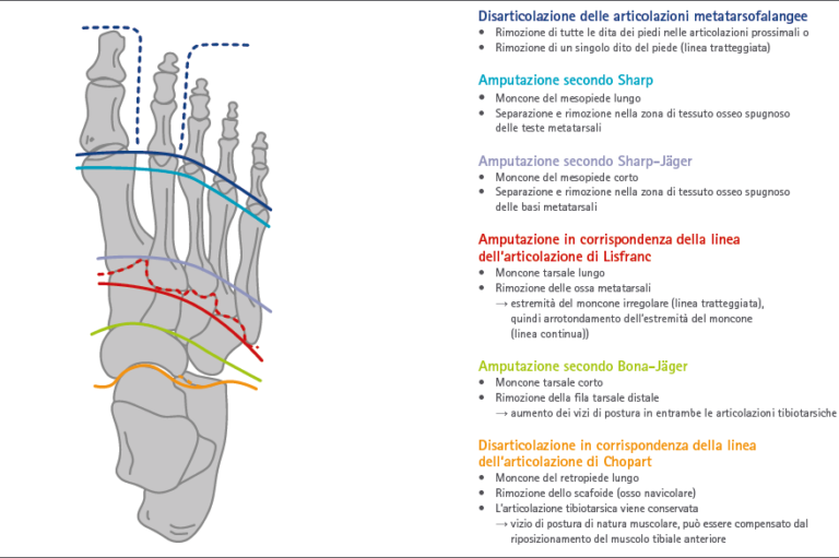 Ortoprotesi per amputazioni parziali del piede e malformazioni ...